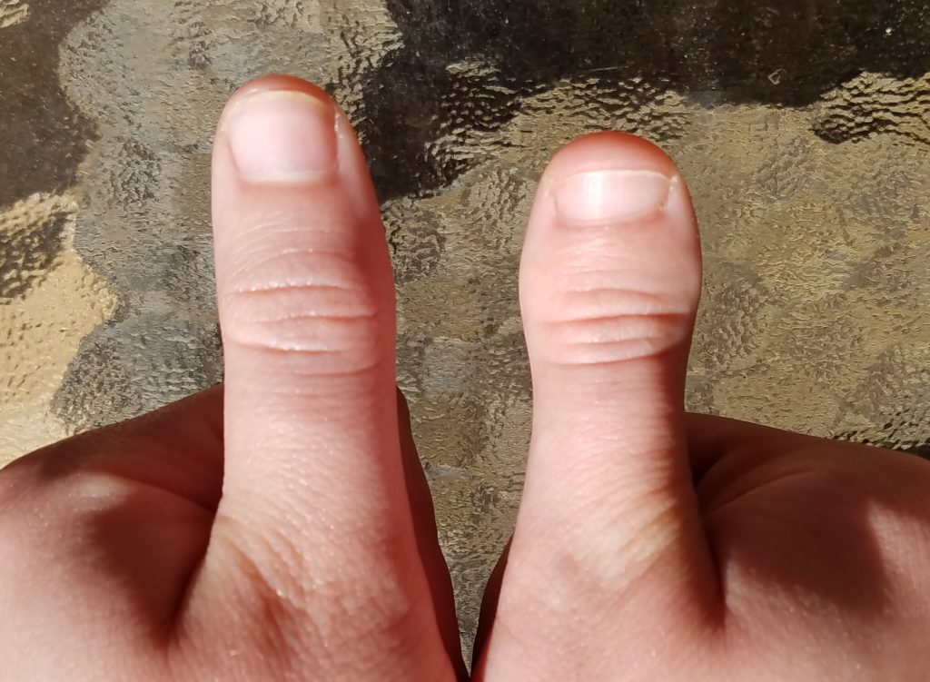 My Stubby Thumb: Mutation or Super Power? - Muse Like Me