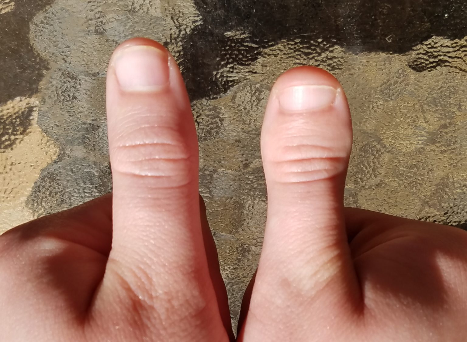 My Stubby Thumb: Mutation or Super Power? - Muse Like Me